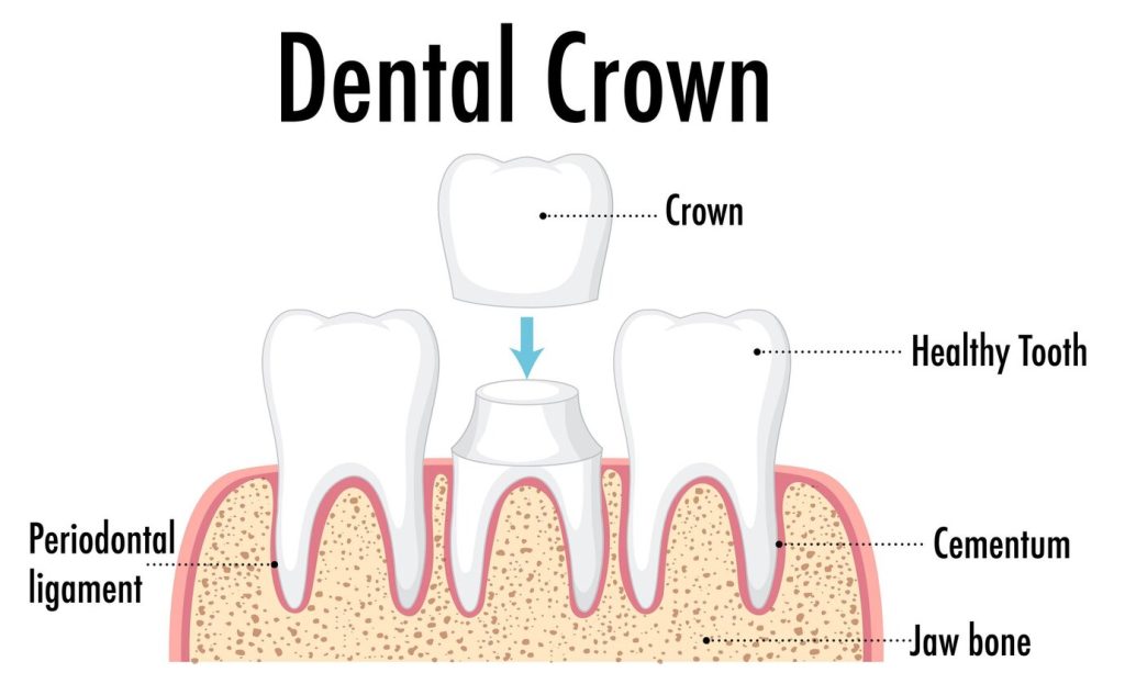 Mengapa Gigi Sensitif Bisa Muncul Setelah Prosedur Dental Crown ...