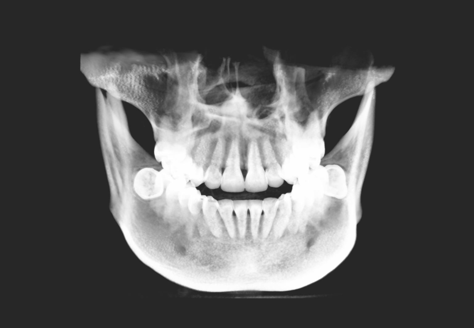 Radiografi Bitewing Digital untuk Deteksi Karies Sekunder Restorasi ...