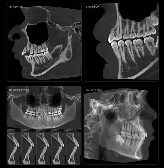 CBCT untuk Evaluasi Hubungan Akar pada Molar Maksila dengan Dasar Sinus ...