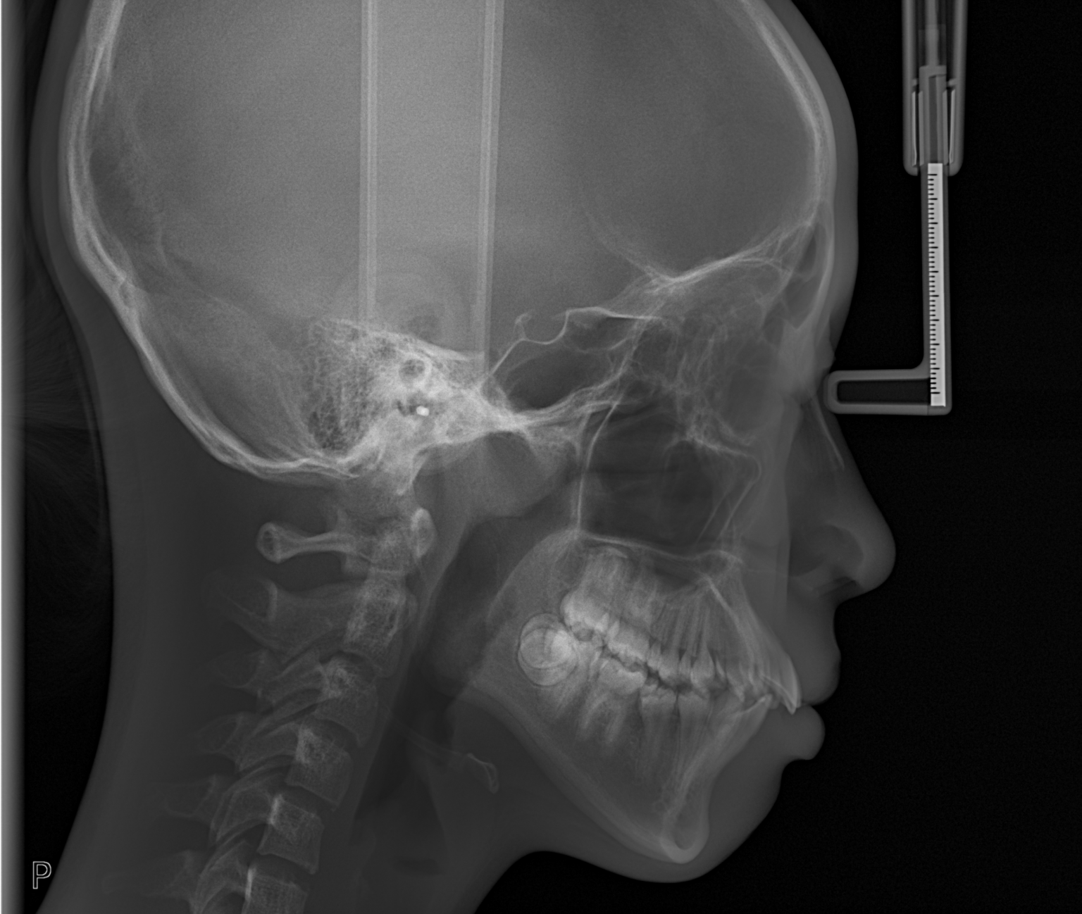 Radiografi Lateral Cephalometric untuk Analisis Sudut Fasial - Fakultas ...
